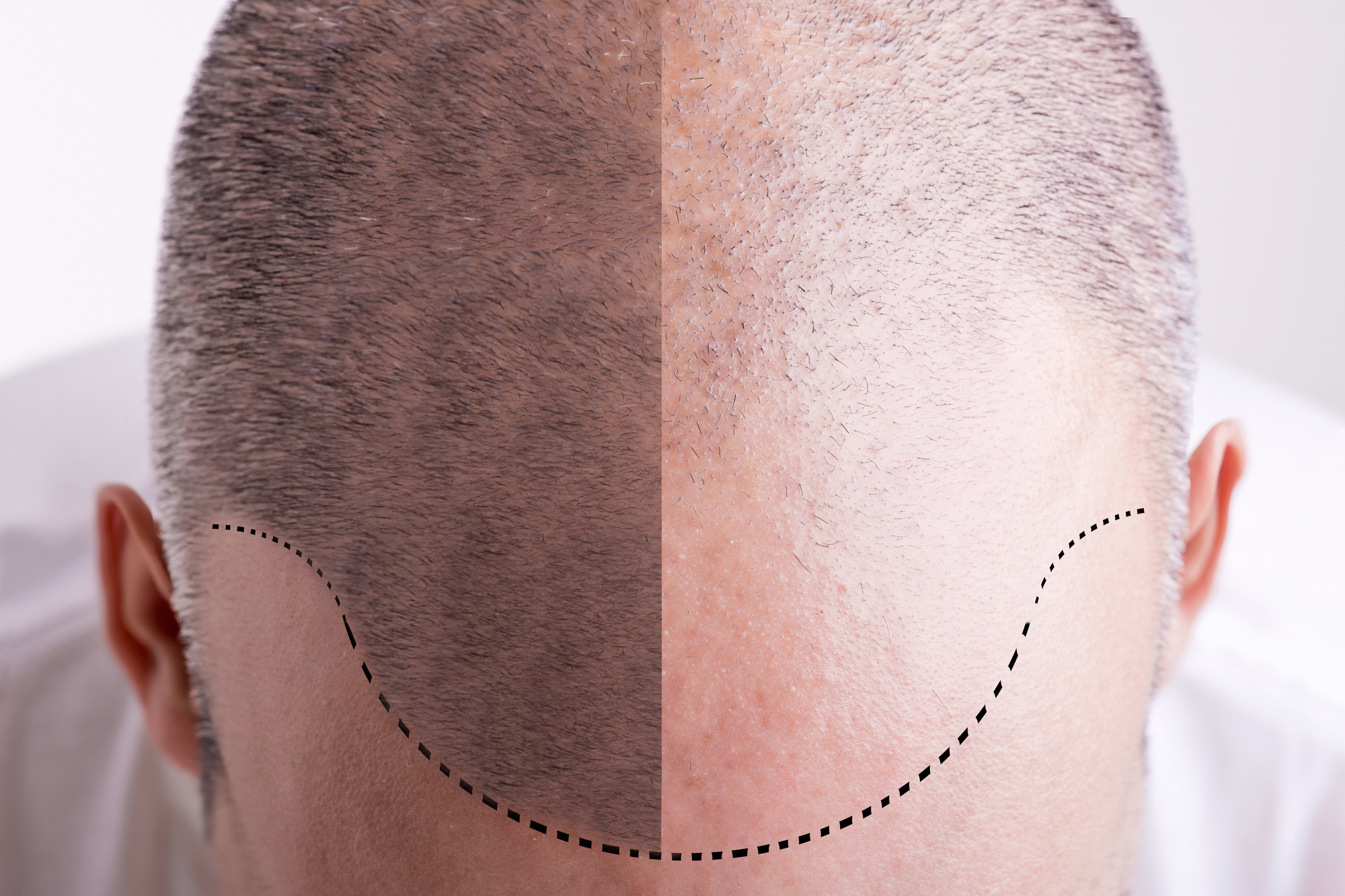 Going Bald at 30? Here’s What You Need to Know! - GenThirty